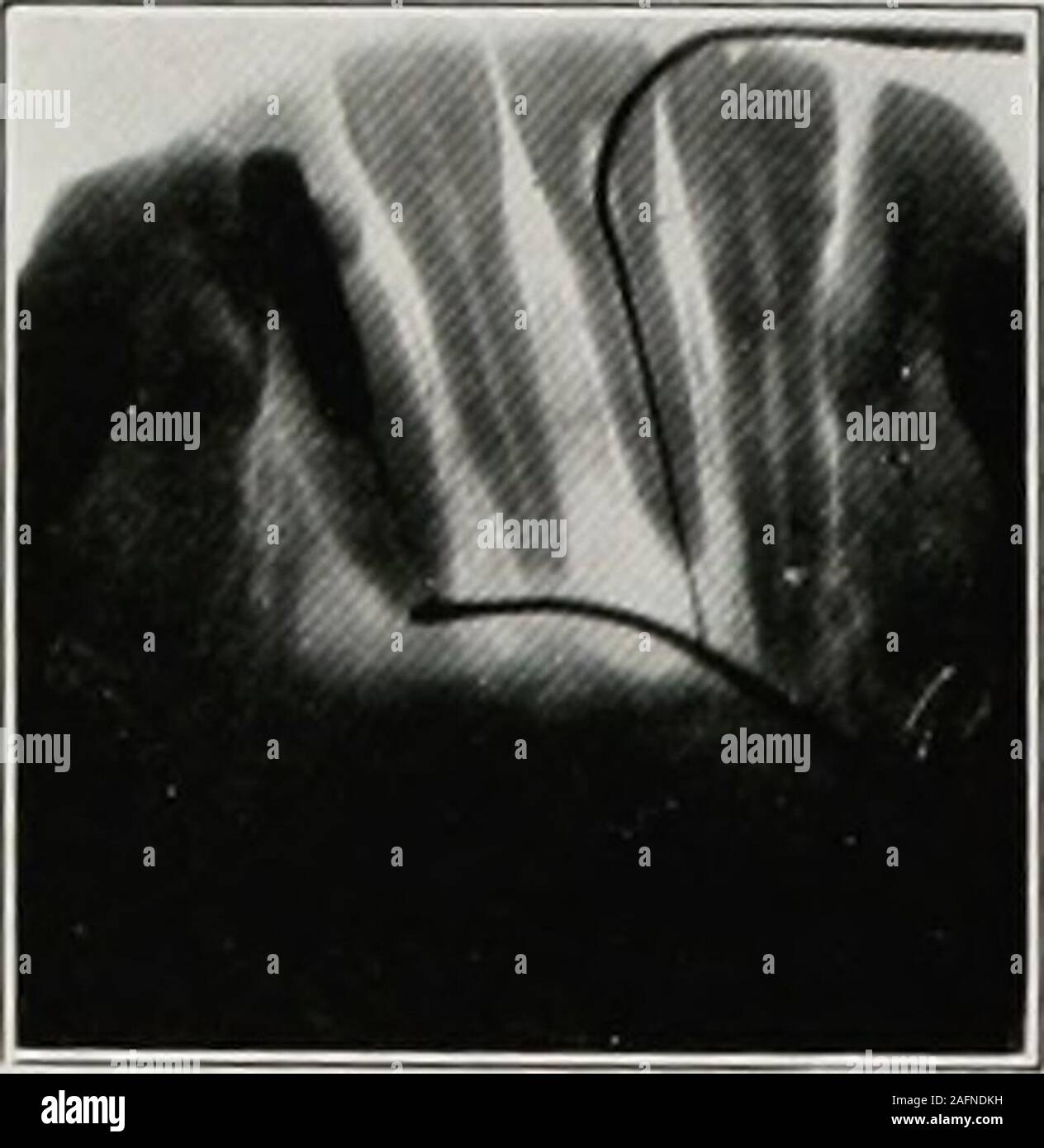 . Dental electro-therapeutics. Fig. 100.—A case of fistula opening on ...