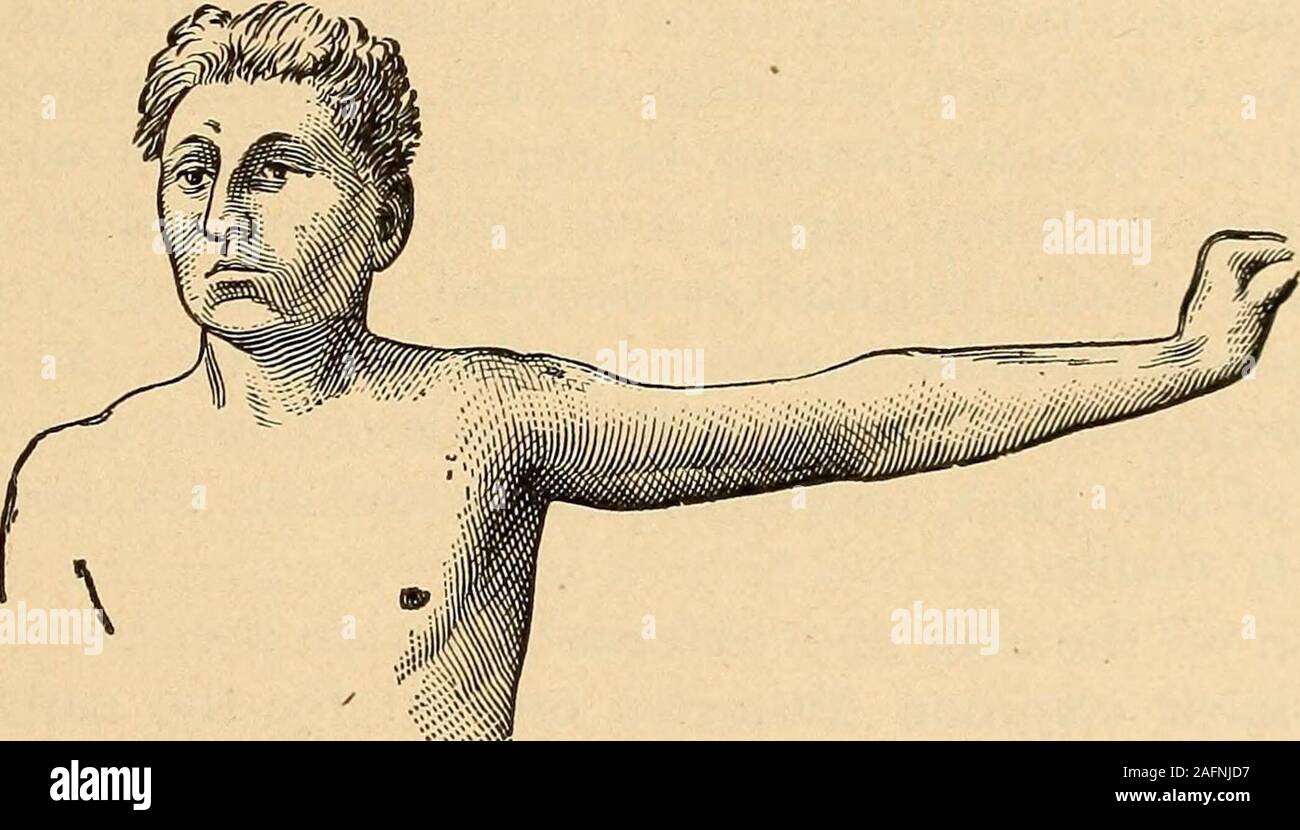 . A practical treatise on fractures and dislocations. near the side ...