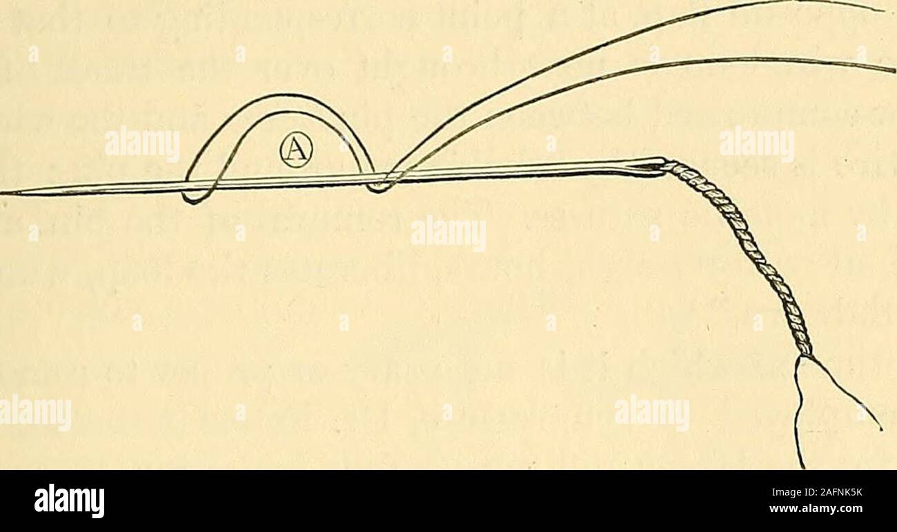 . The principles and practice of surgery. Second Method. ACUPRESSURE ...