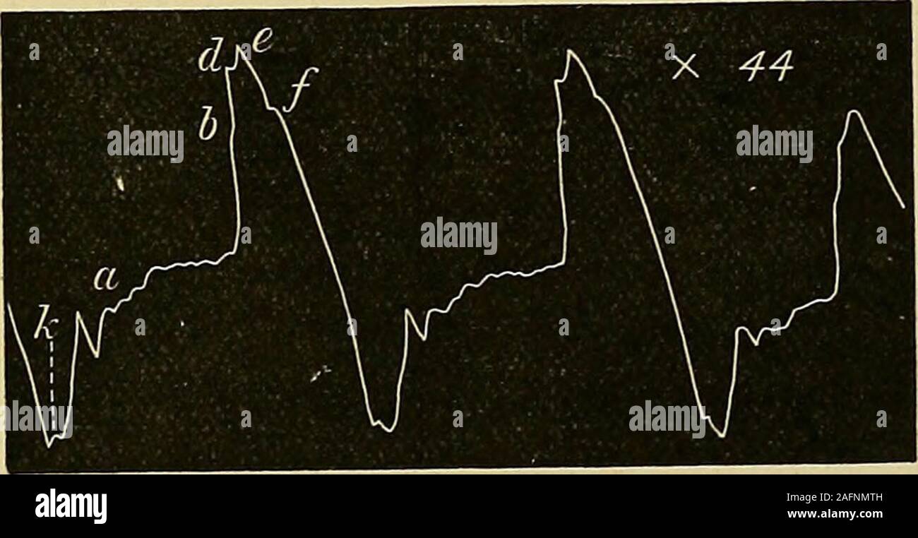 . Diseases of the heart and thoracic aorta. Fig. 310. — Cardiogram from ...