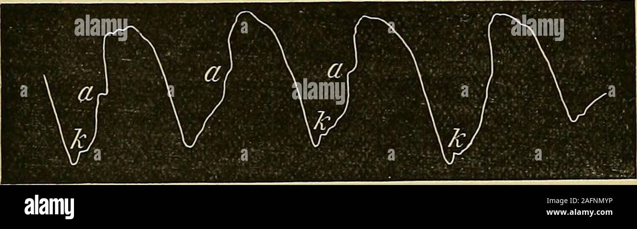 . Diseases of the heart and thoracic aorta. Fig. 309.— Cardiogram in a ...