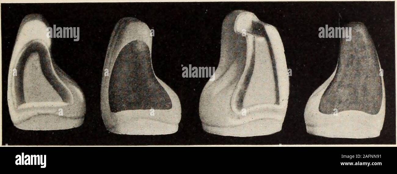 Tooth thickness hi-res stock photography and images - Alamy