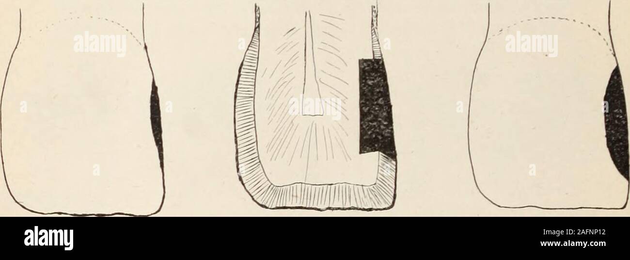 Occlusal force hi-res stock photography and images - Alamy