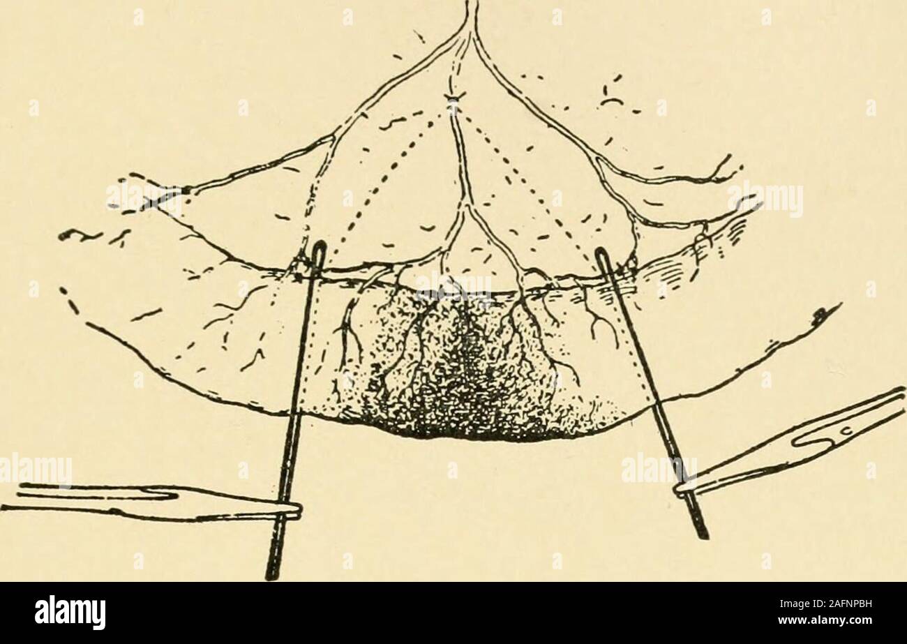 Small intestine sec hi-res stock photography and images - Alamy