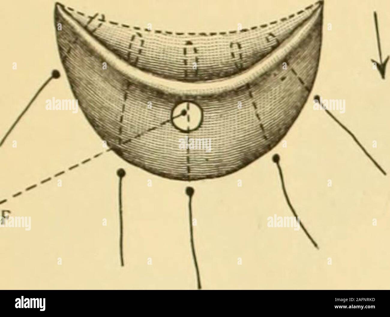. Clinical gyncology, medical and surgical. Triangular denudation ...