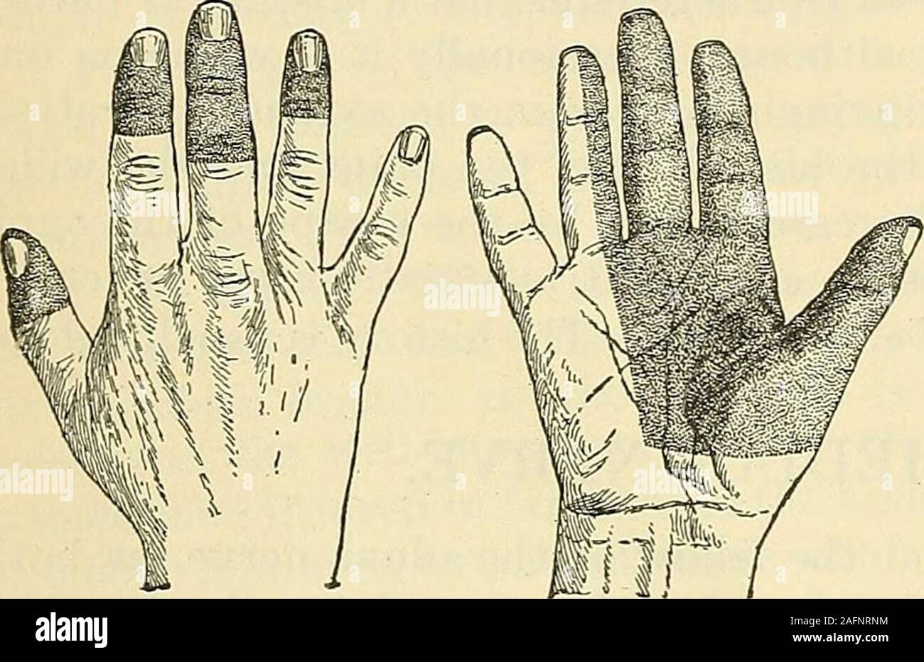 Wrist Abduction And Adduction