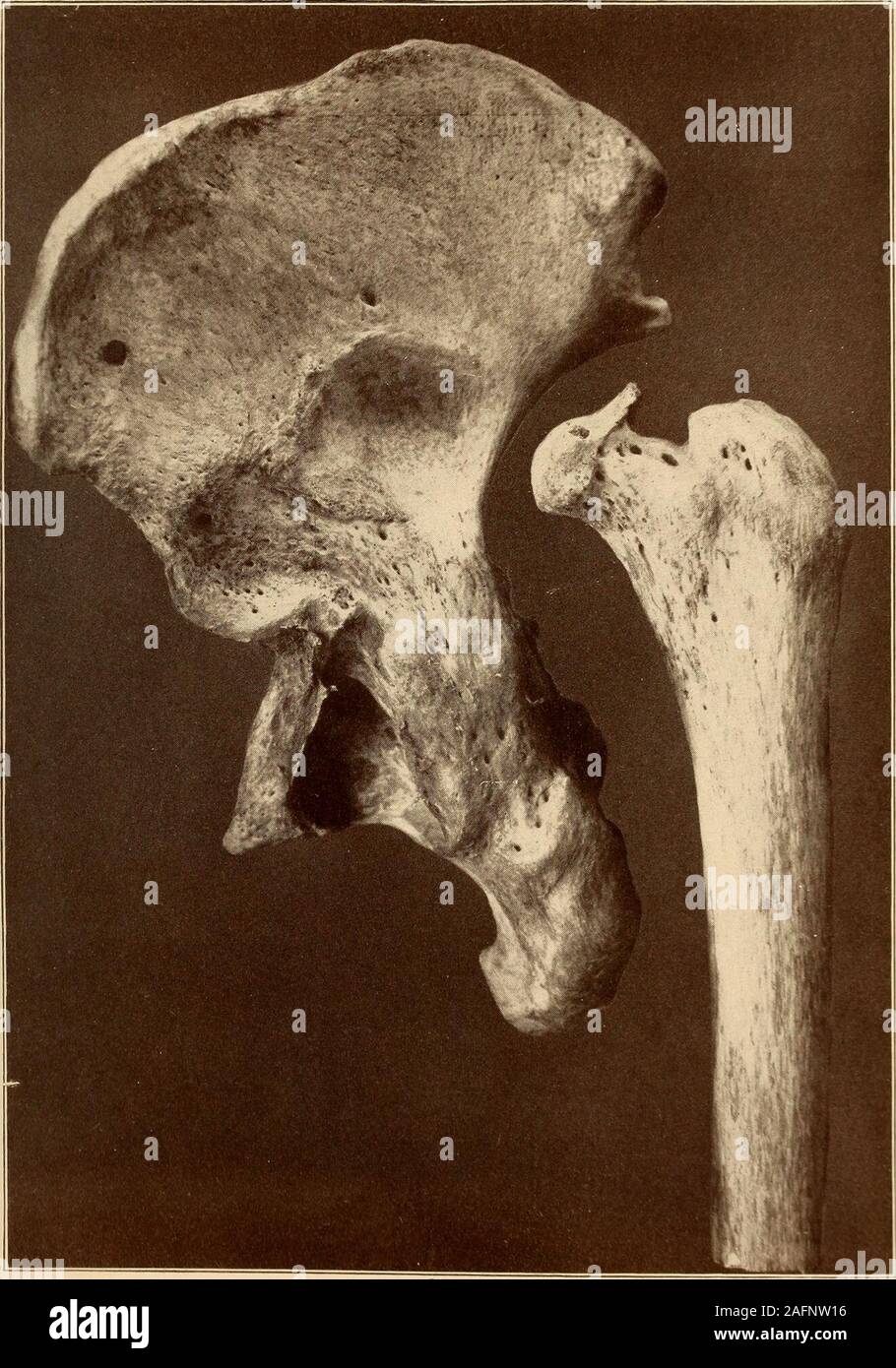 Lesser trochanter hi-res stock photography and images - Alamy