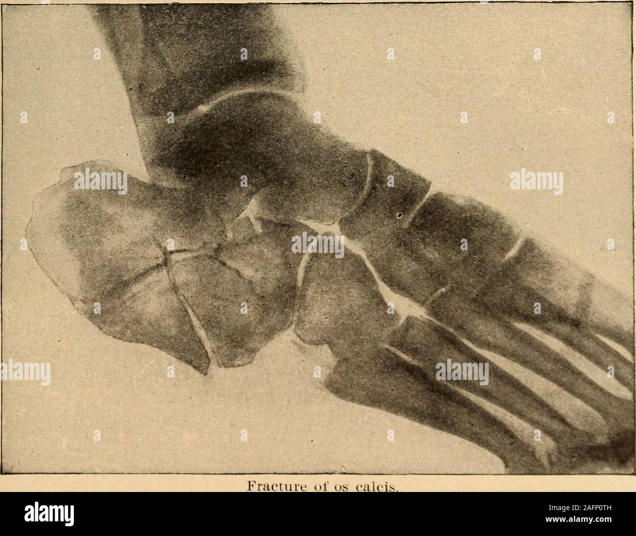Sustentaculum tali hi-res stock photography and images - Alamy