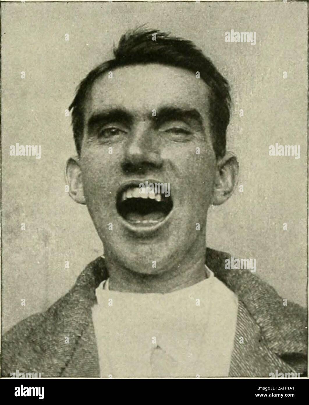 Pseudobulbar palsy hi-res stock photography and images - Alamy