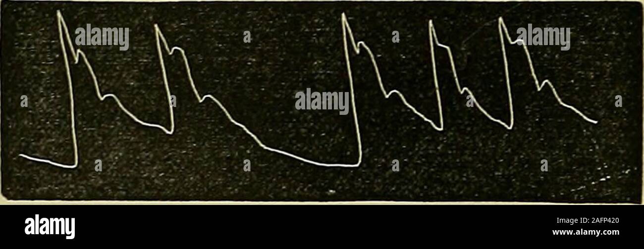 . Diseases of the heart and thoracic aorta. Piessiire 3 oz.Fig. 275 ...