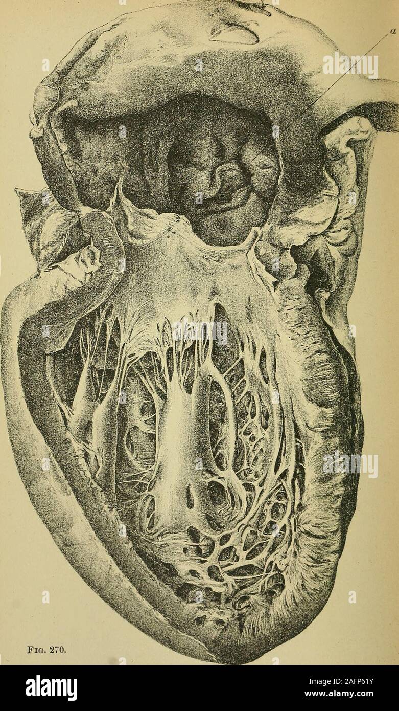 . Diseases of the heart and thoracic aorta. Fig. 269, Aneurism ...