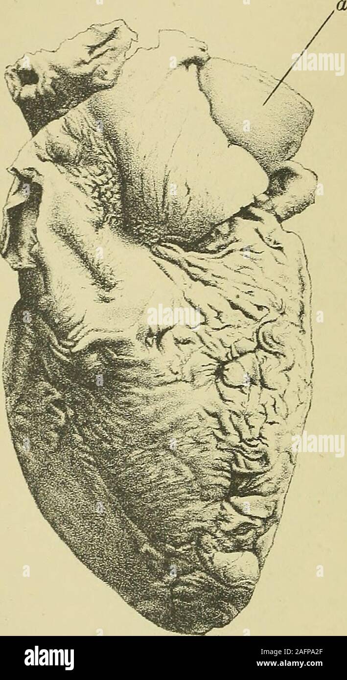 . Diseases of the heart and thoracic aorta. Fig. 255.—Atrophy of the ...