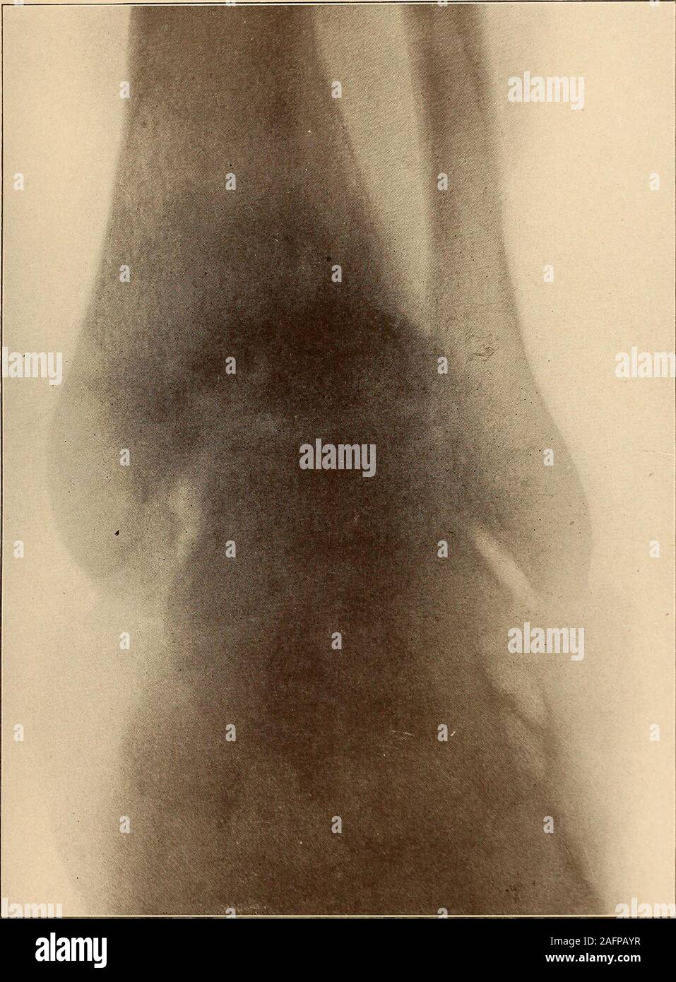 . A practical treatise on fractures and dislocations. Potts fracture by ...