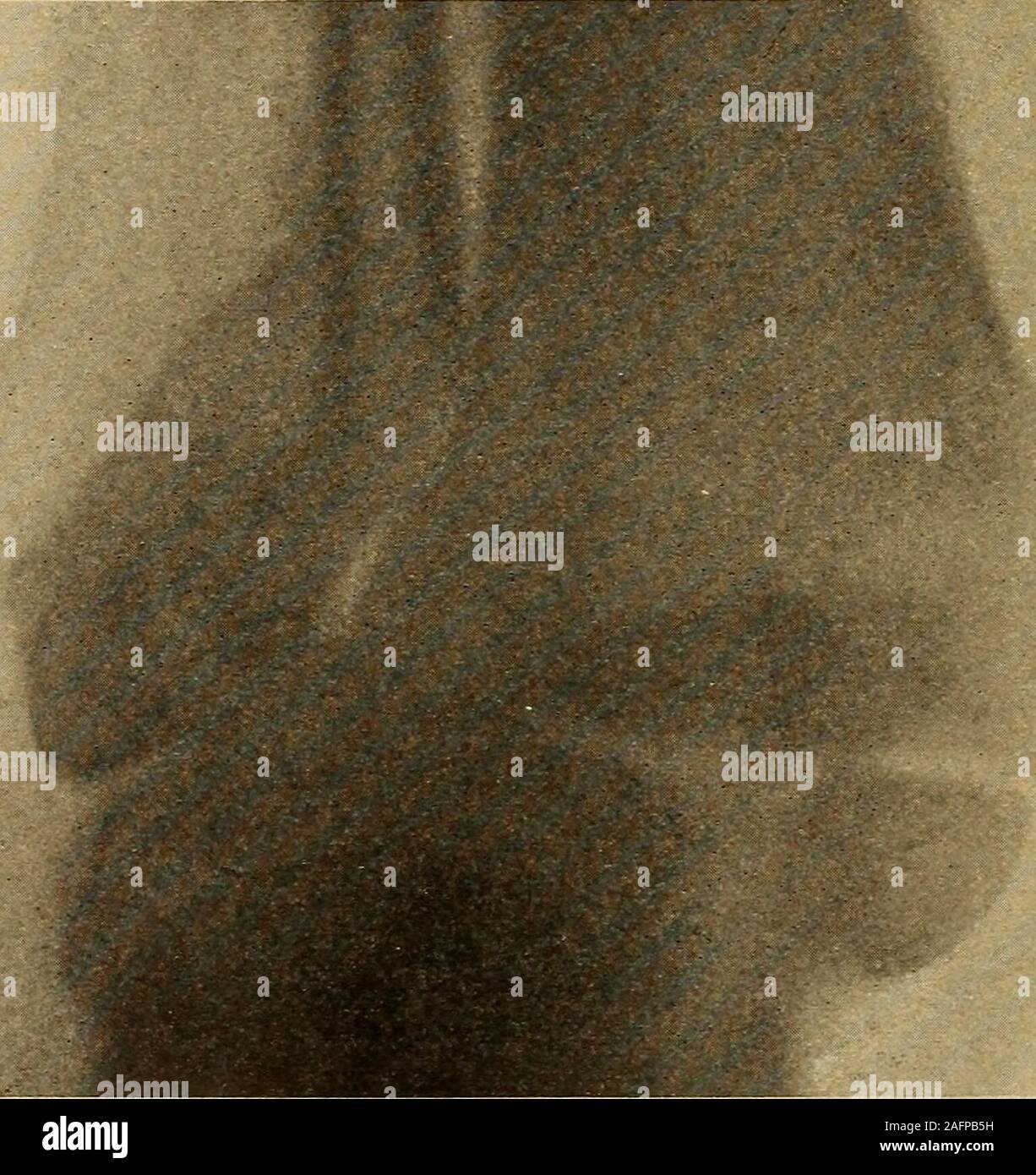 . A practical treatise on fractures and dislocations. Potts fracture ...