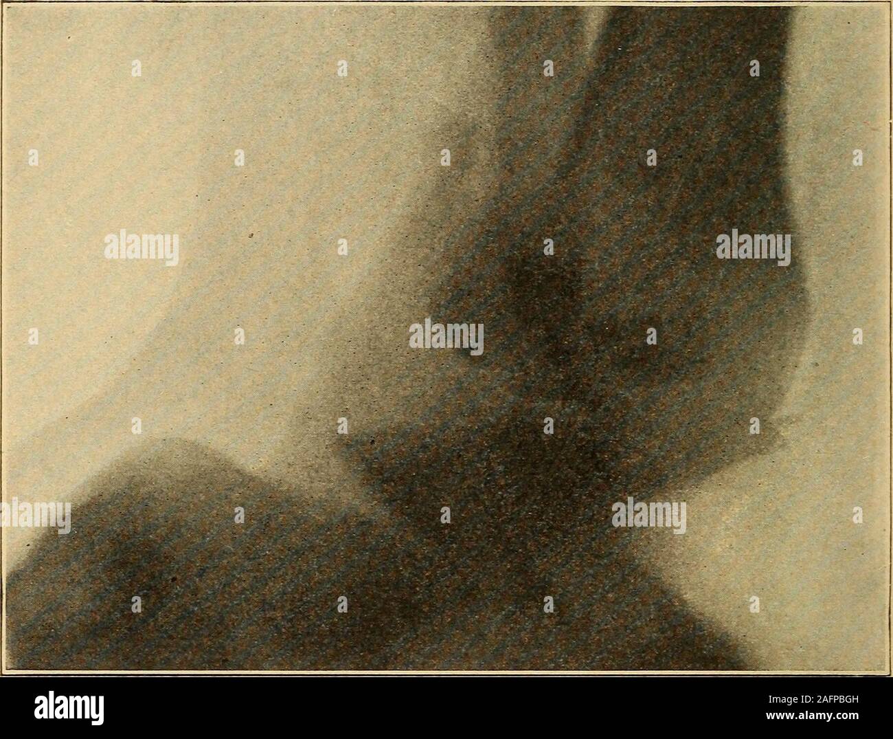 . A practical treatise on fractures and dislocations. Totts fracture bv ...