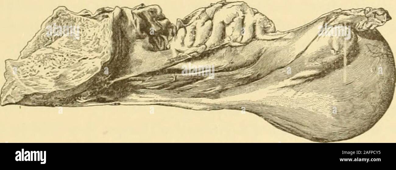 . Clinical gyncology, medical and surgical. Cyst of the parovarium ...