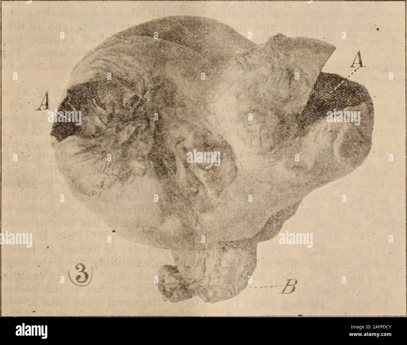 . Virginia medical semi-monthly. Kio. 2.—Uterus and appendages from ...