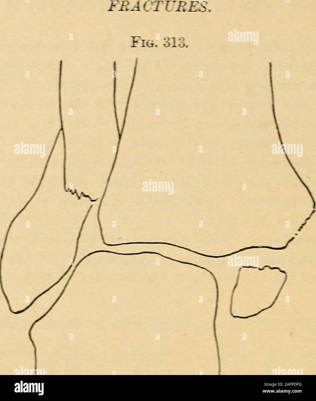 Fibular fracture hi-res stock photography and images - Alamy