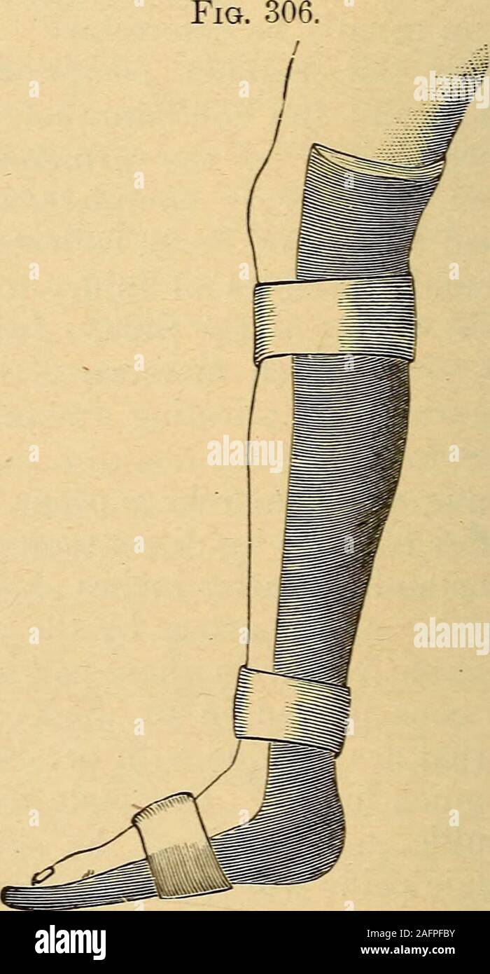 Plaster Splint Gypsum High Resolution Stock Photography and Images - Alamy