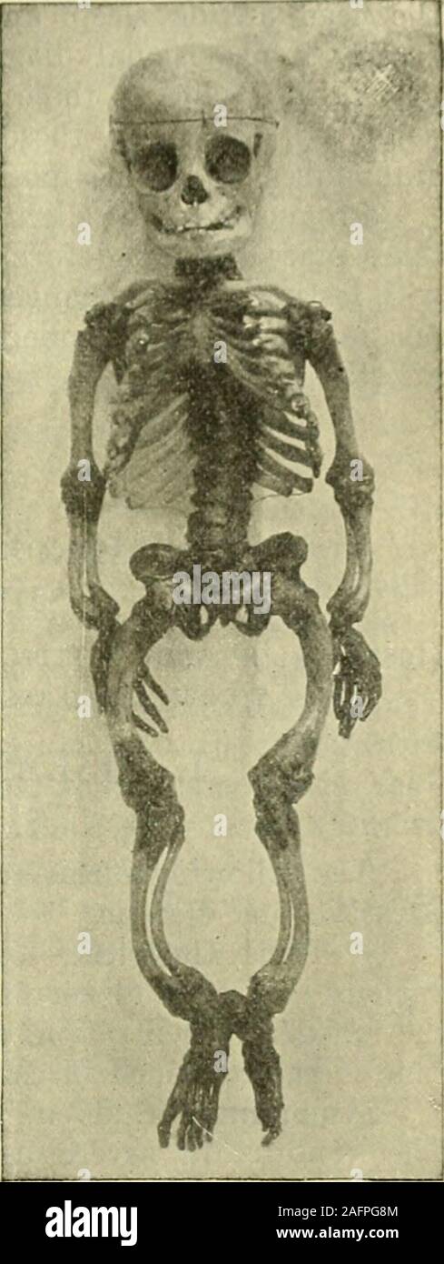 Rickets child hi-res stock photography and images - Alamy