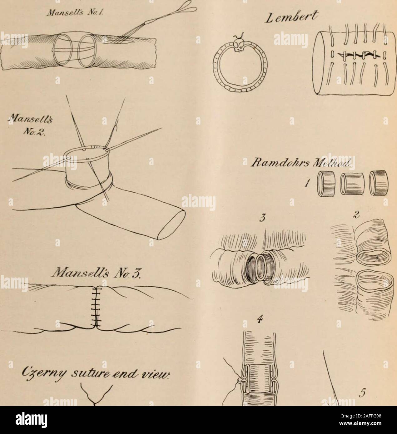 . Virginia medical semi-monthly. longi-tudinal incision being closed by ...
