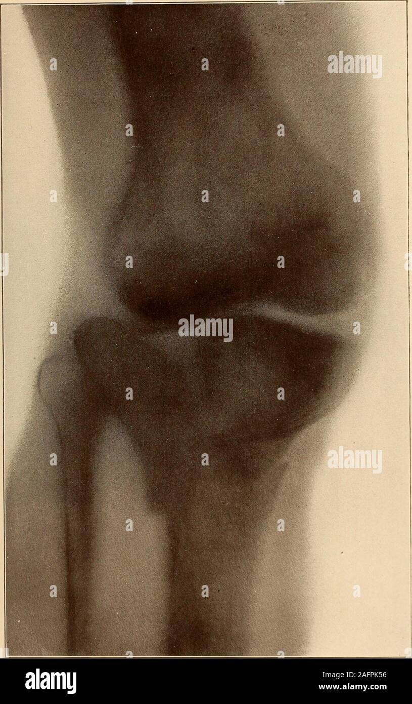 . A practical treatise on fractures and dislocations. Fracture of upper ...