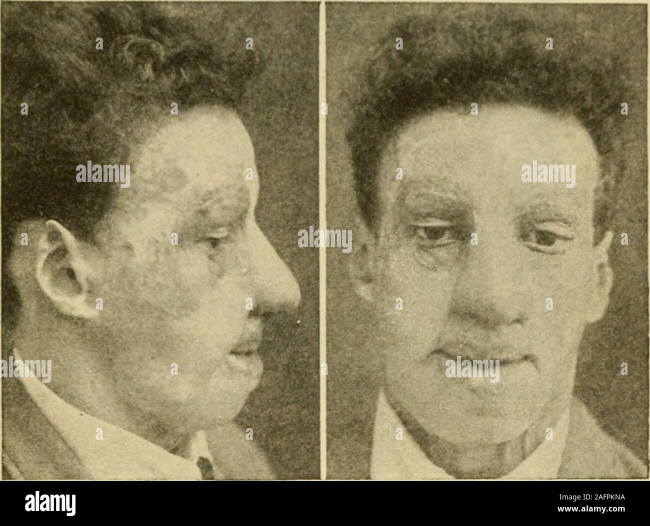 . Manual of operative surgery. Fig. 1604.—Left pedicle swung to the ...