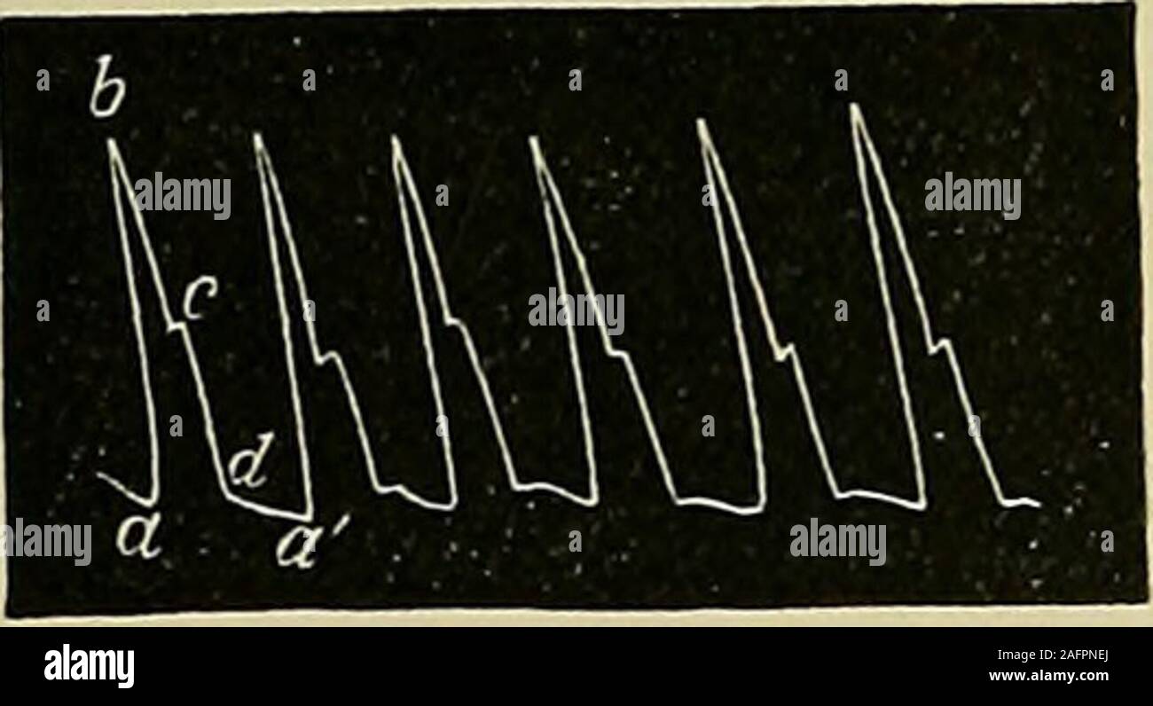. Diseases of the heart and thoracic aorta. , or Corrigans pulse (after ...