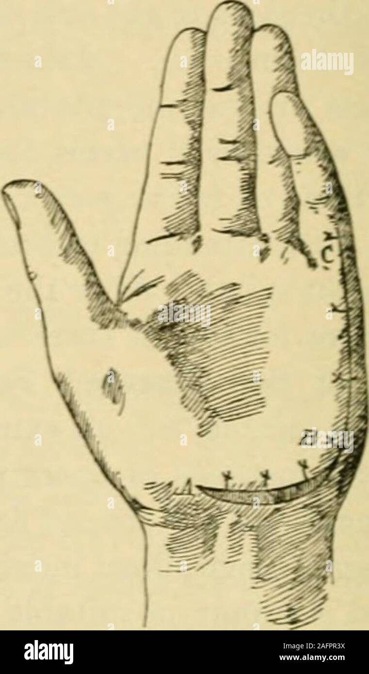 Transverse palmar crease hi-res stock photography and images - Alamy