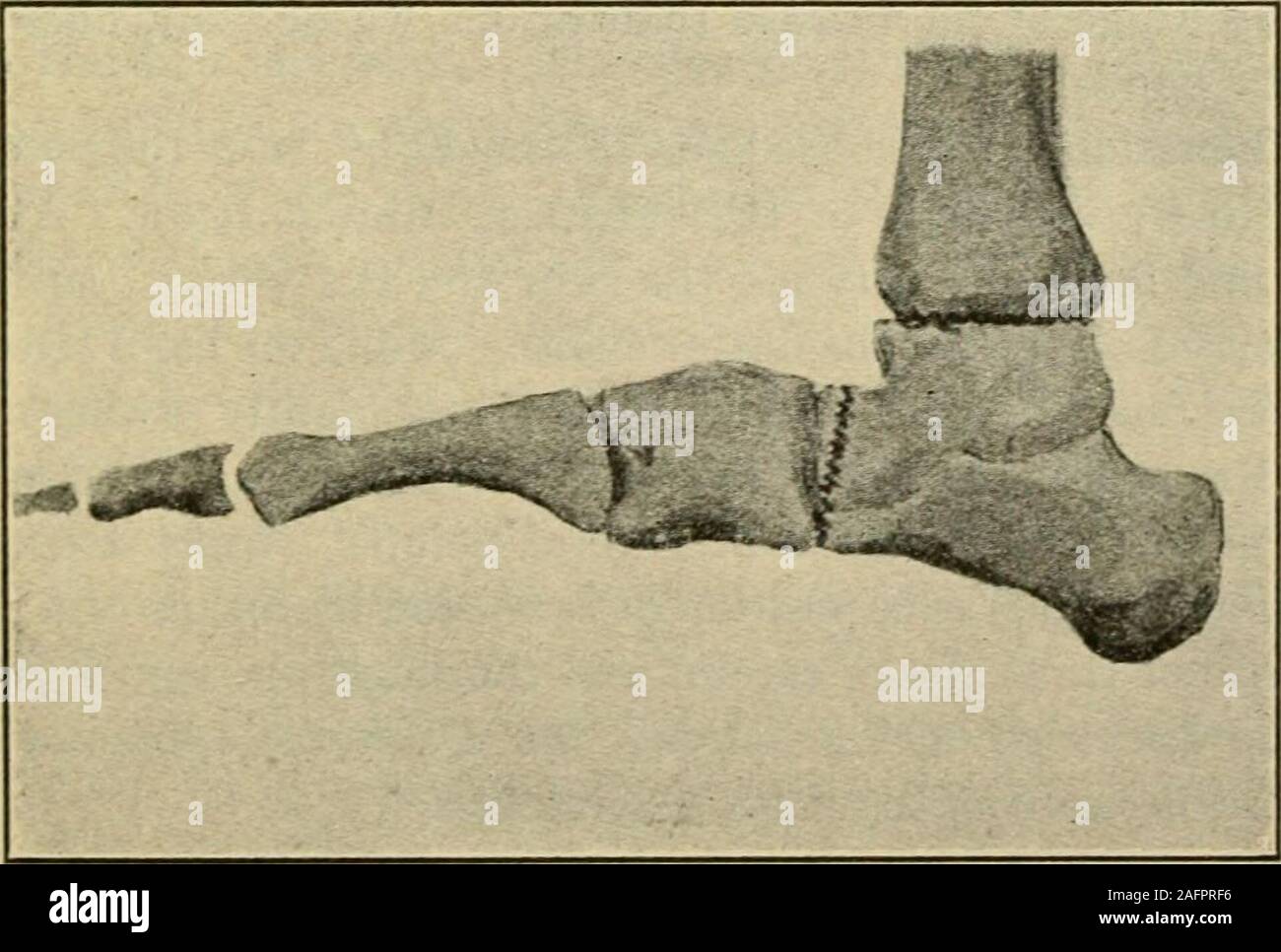 . Manual of operative surgery. Fig. 1586.—Jones operation talipes ...