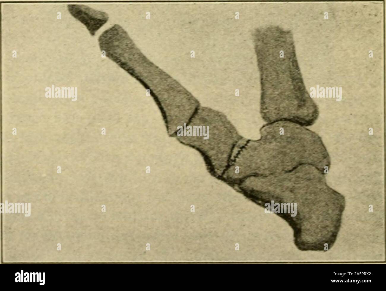 . Manual of operative surgery. Jones operation talipes calcaneo-caus ...