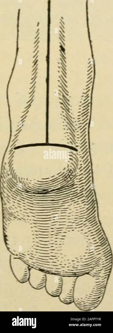 . Manual of operative surgery. Fig. 1577.—Application of Jonessplints ...