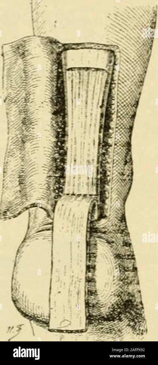 Tenotomy hi-res stock photography and images - Alamy