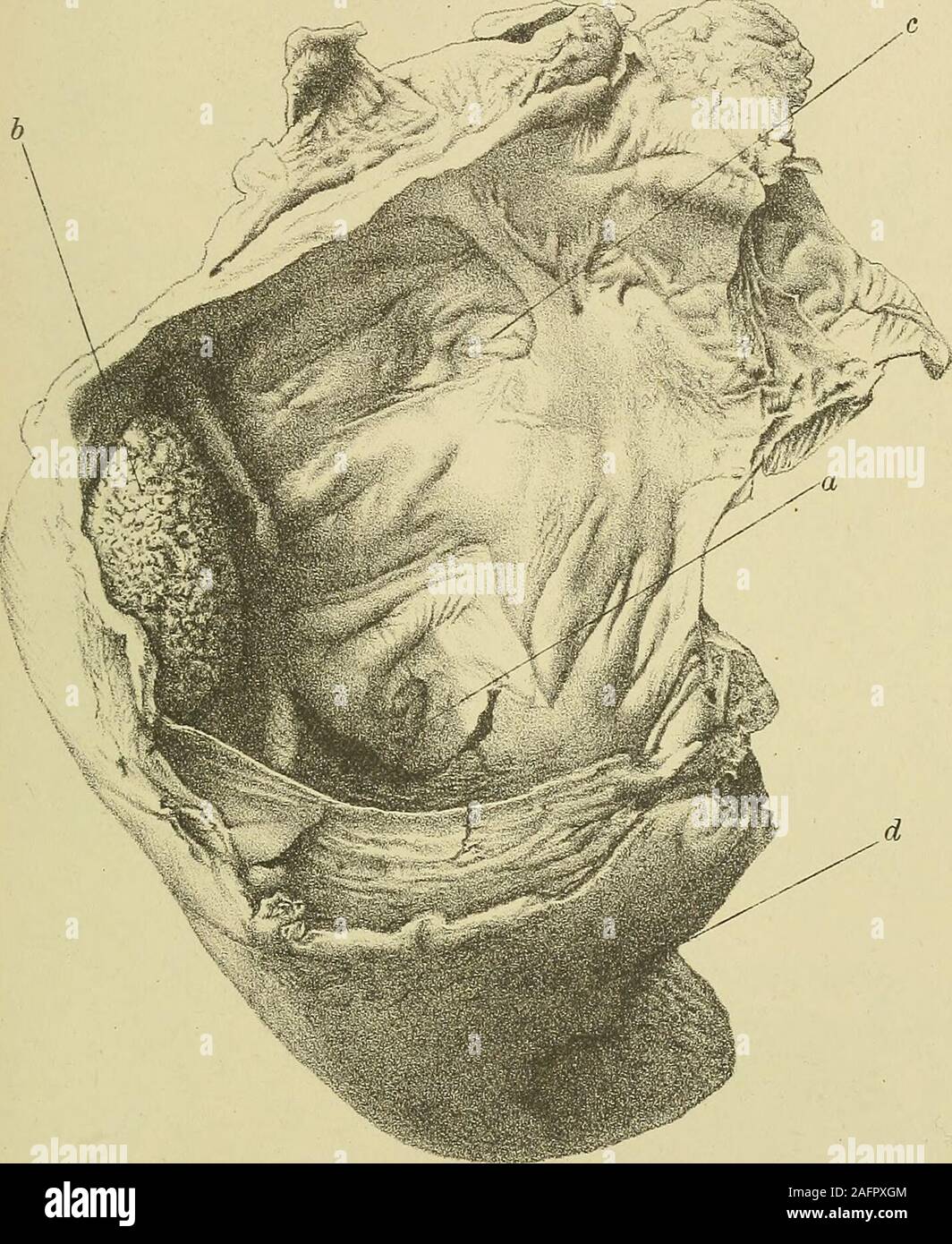 Calcified aorta hi-res stock photography and images - Alamy