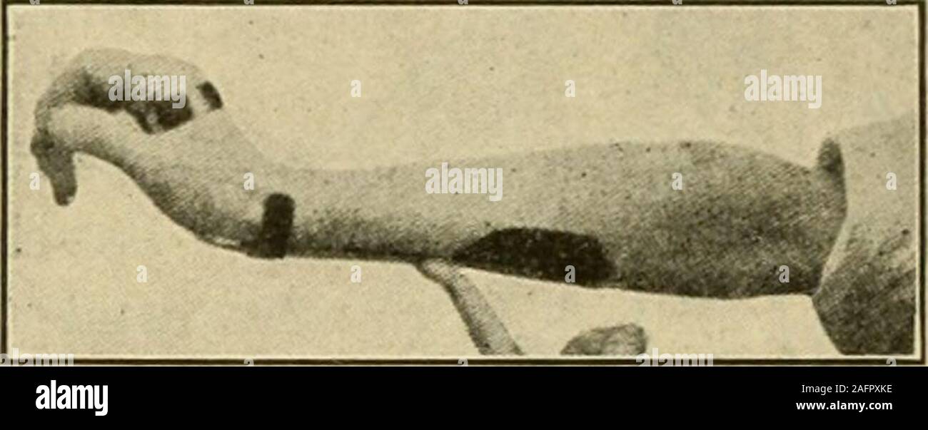 . Manual of operative surgery. Fig. 1559.—Dorsiflexed wrist splintto ...