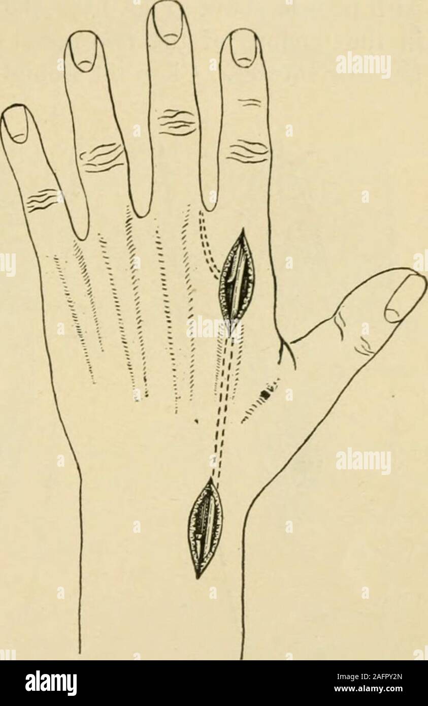. Manual of operative surgery. Fig. 1554. Fig. 1555. Figs. 1554 and ...