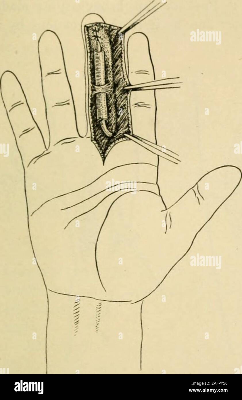 . Manual of operative surgery. middle finger as a result of a deep ...