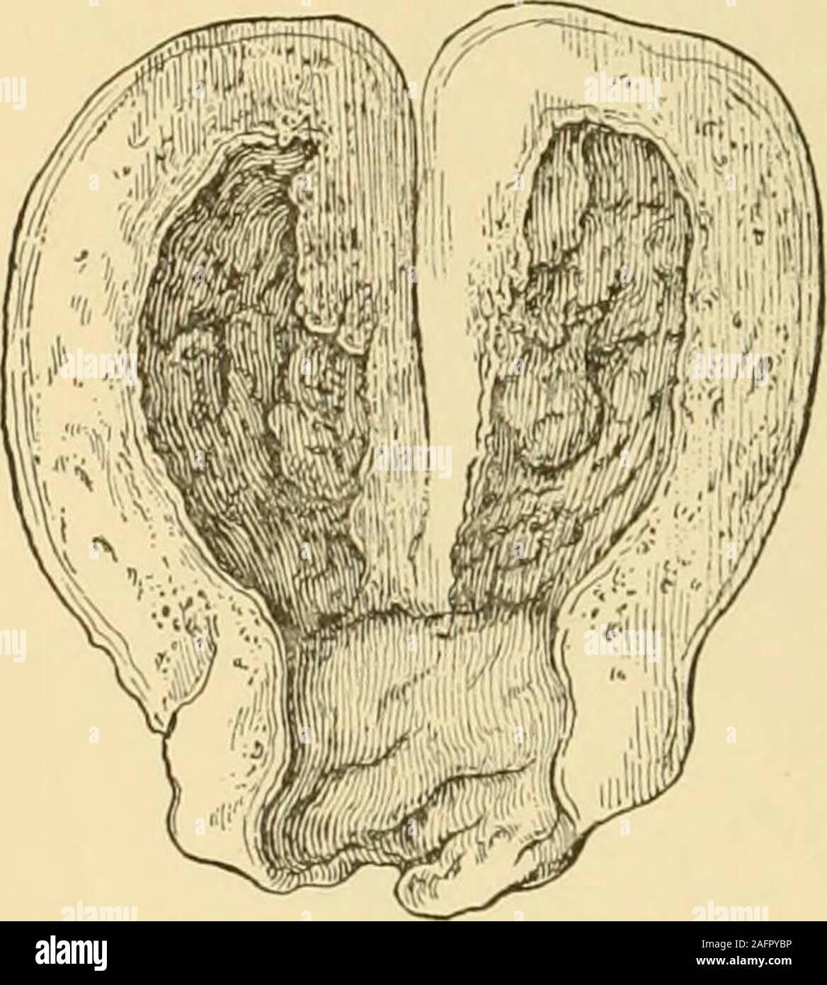 Cervical canal of uterus hi-res stock photography and images - Alamy
