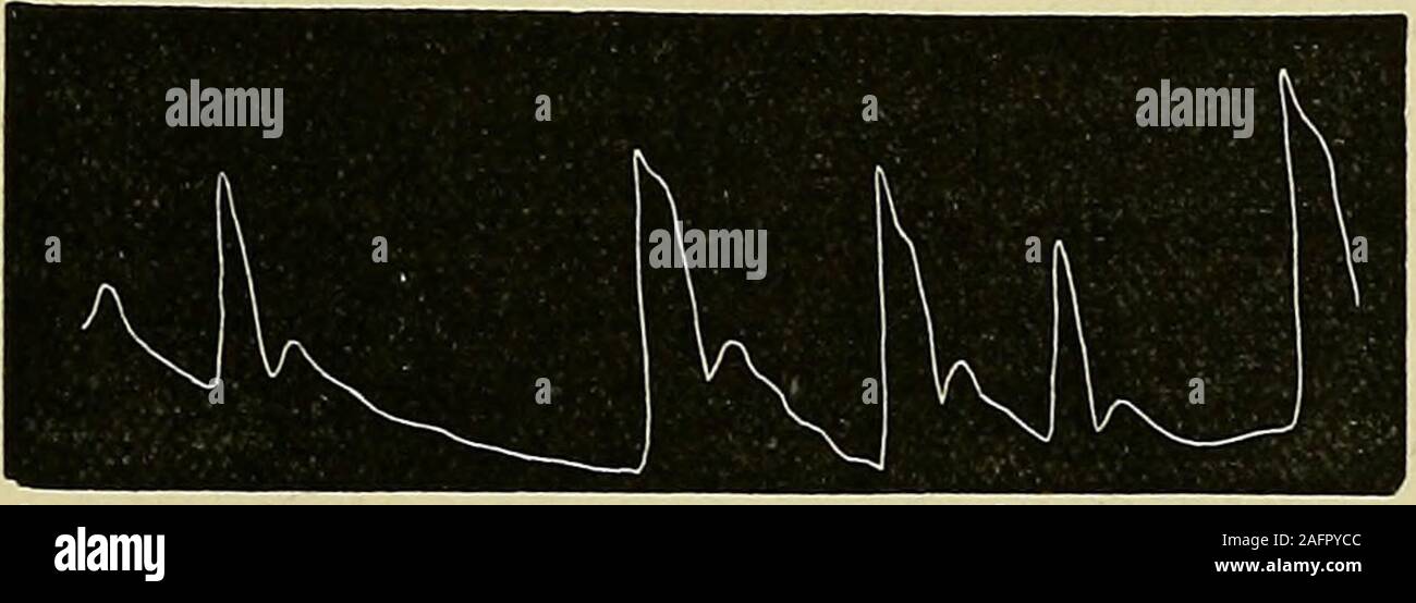 . Diseases of the heart and thoracic aorta. Pressure i^ oz.Fig 187 ...