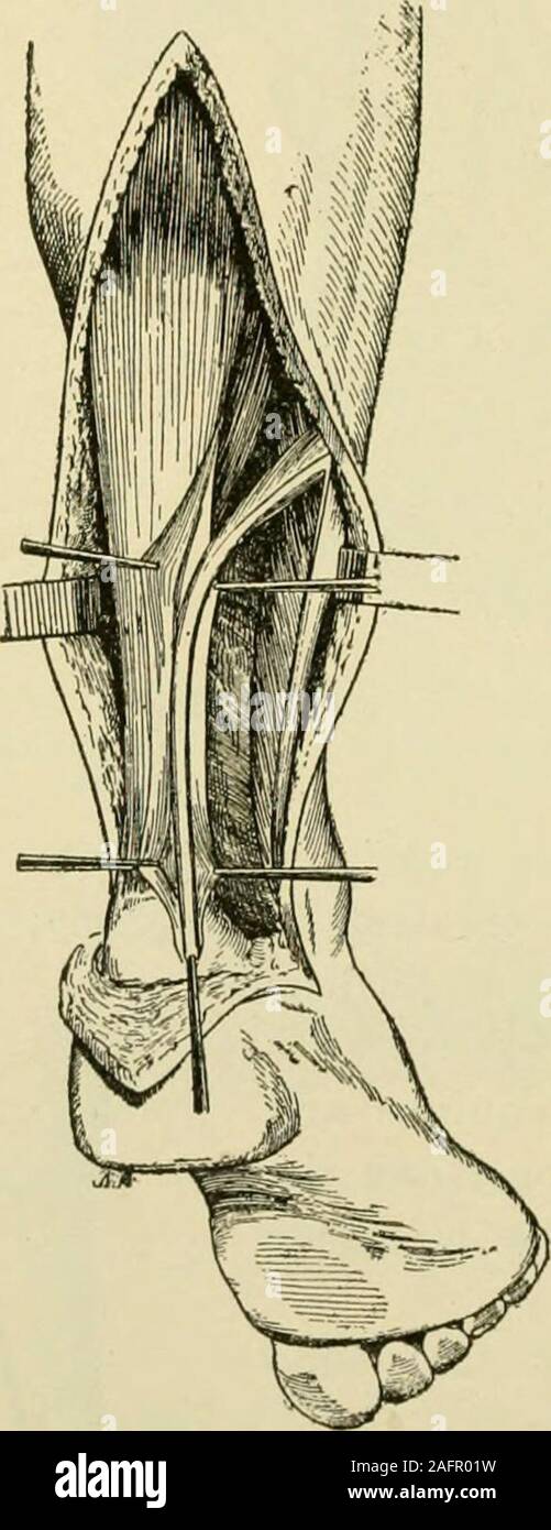 . Manual of operative surgery. d retract the external saphenous vein ...