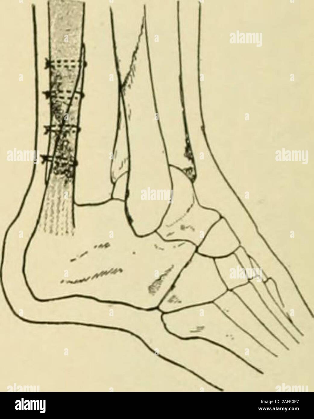 To remove the tendon hi-res stock photography and images - Alamy