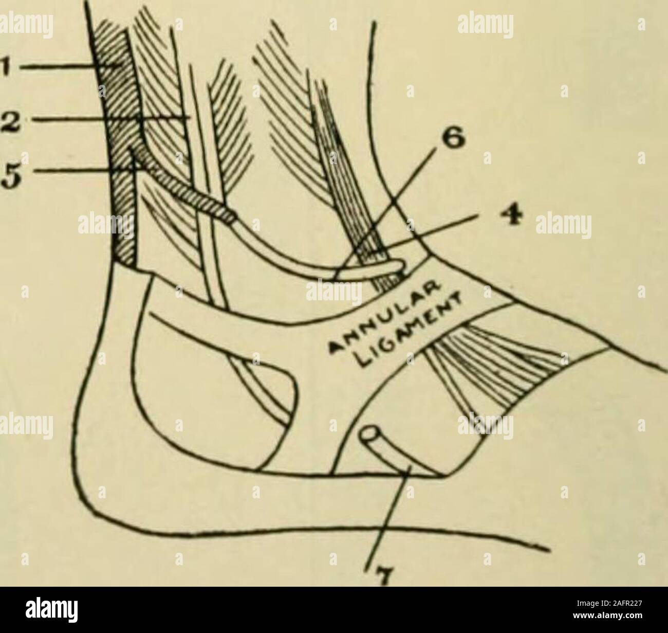 . Manual of operative surgery. Fig. 1537. I. Tendo Achillis. 2 ...
