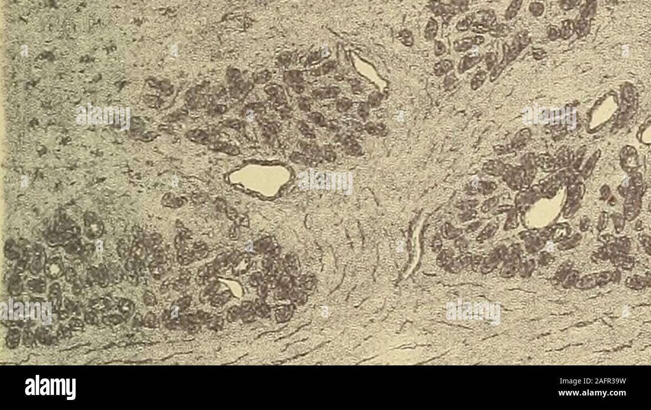 Carditis hi-res stock photography and images - Alamy