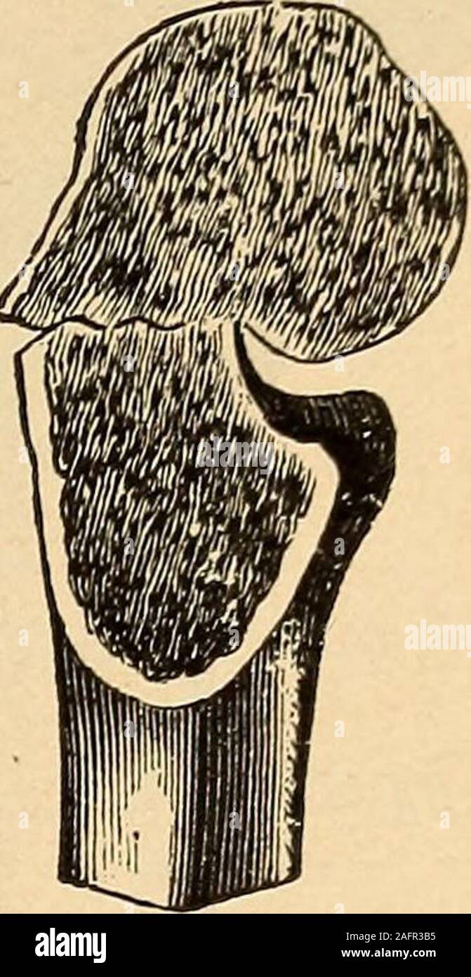 Intracapsular fractures hi-res stock photography and images - Alamy