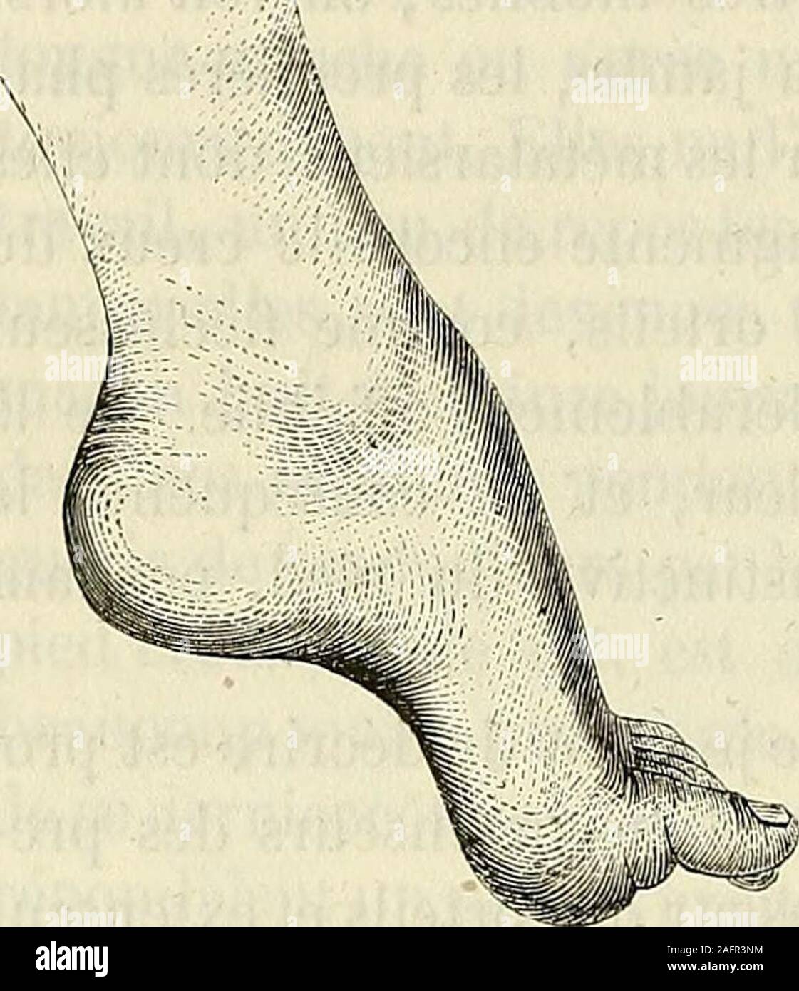 Pathologie du pied hi-res stock photography and images - Alamy