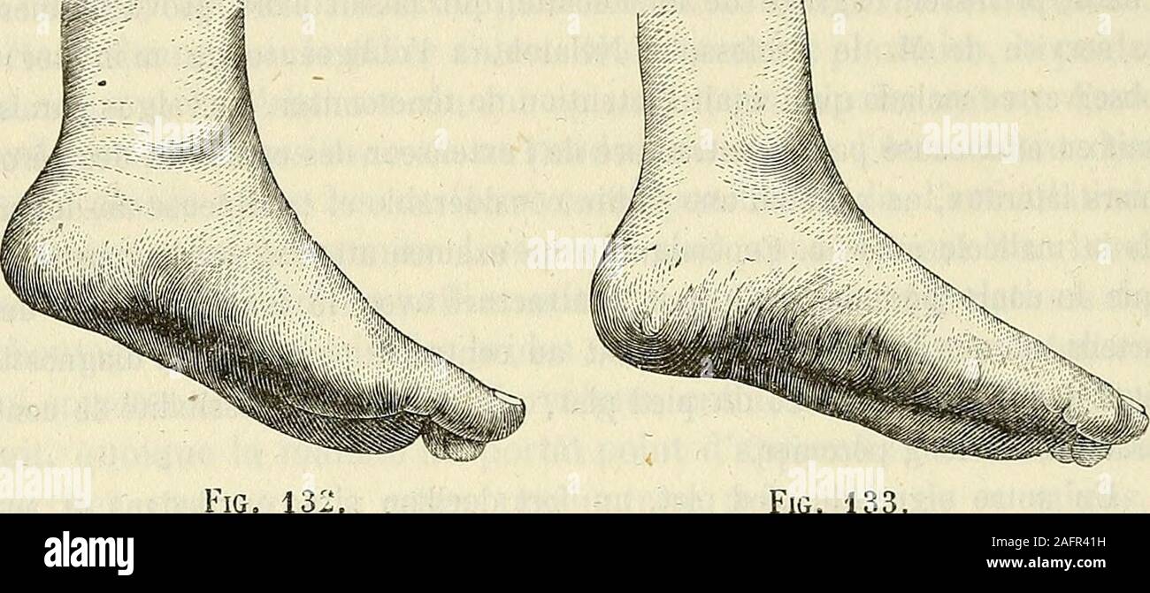 Pathologie du pied hi-res stock photography and images - Alamy