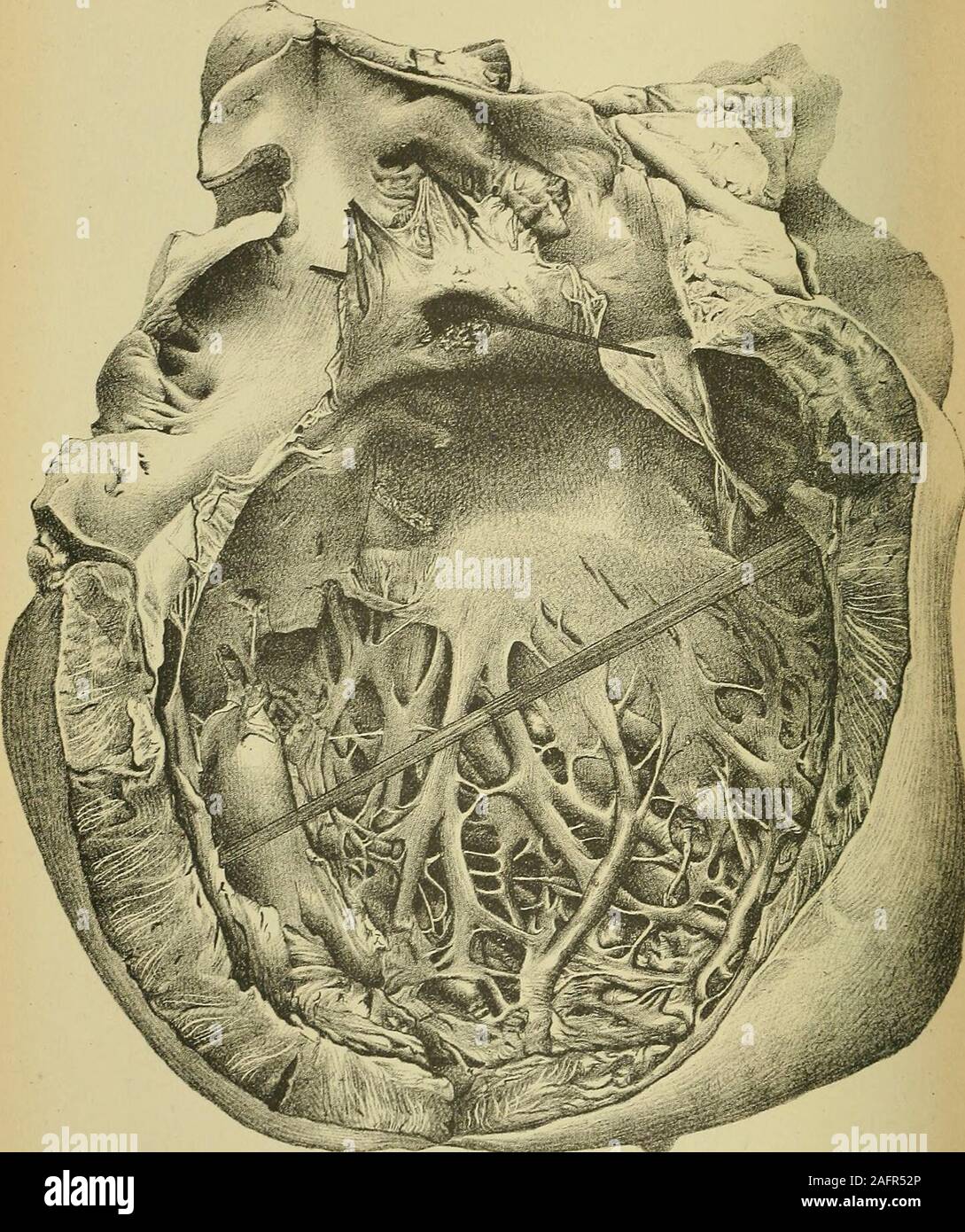 Mitral valve cusp hi-res stock photography and images - Alamy