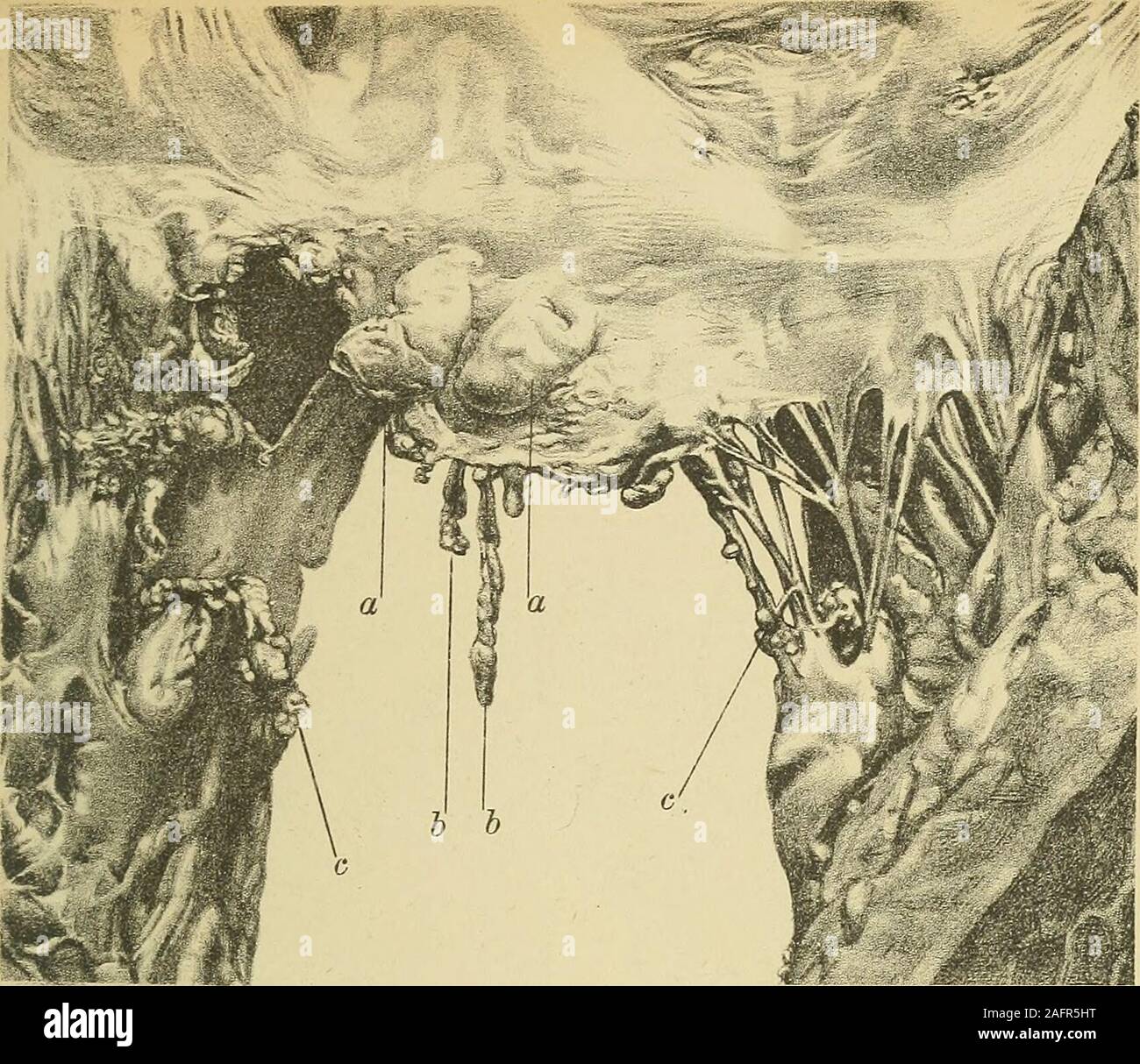 . Diseases of the heart and thoracic aorta. Fig. 169.— Vlceratire ...