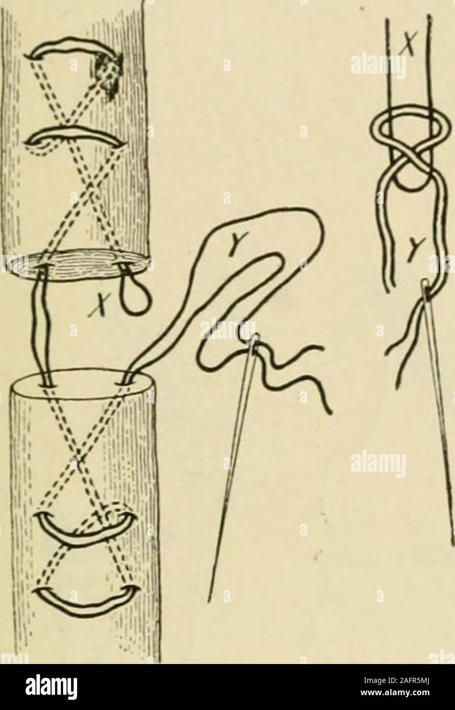 . Manual of operative surgery. ceps up the sheath, seize the tendon ...