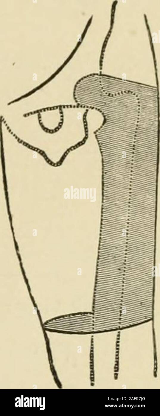 . Manual of operative surgery. lower end of the vertical incision make ...